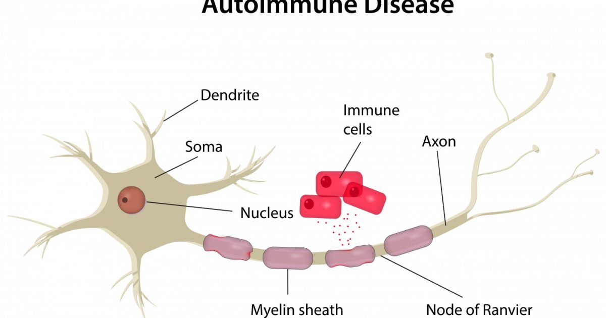 Potential Mechanism in MS Pathogenesis Seen in Study | Multiple ...
