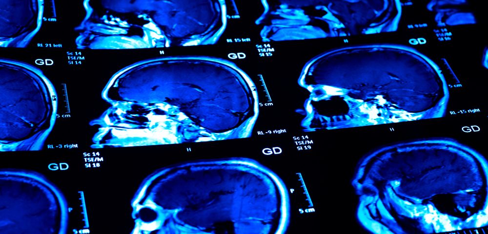 New MRI Method Has Potential to Map MS Progression and Guide Treatment ...
