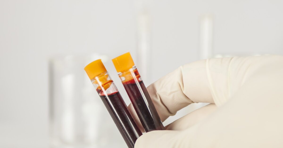 Multiple Sclerosis May Be Spotted Using Simple Blood Test