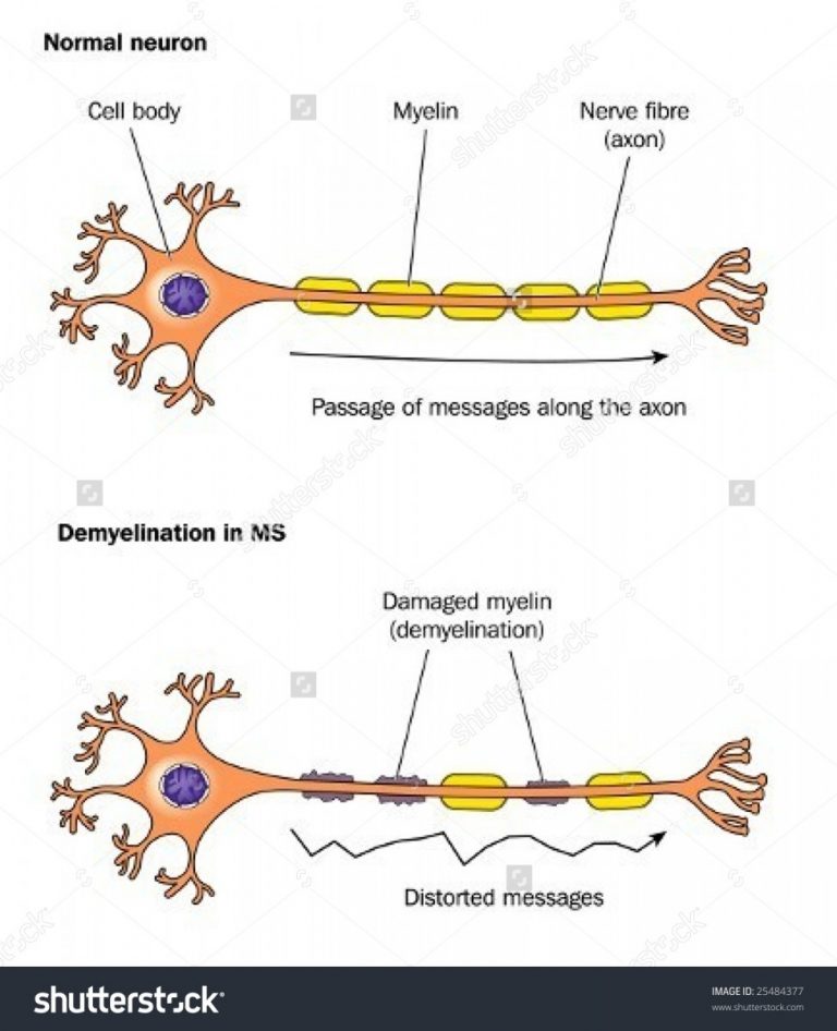 Heat Intolerance - Multiple Sclerosis News Today