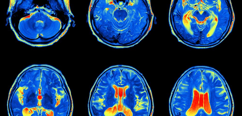 #CMSC17 - RRMS Patients Sustain Efficacy for Over 6 Years Without ...