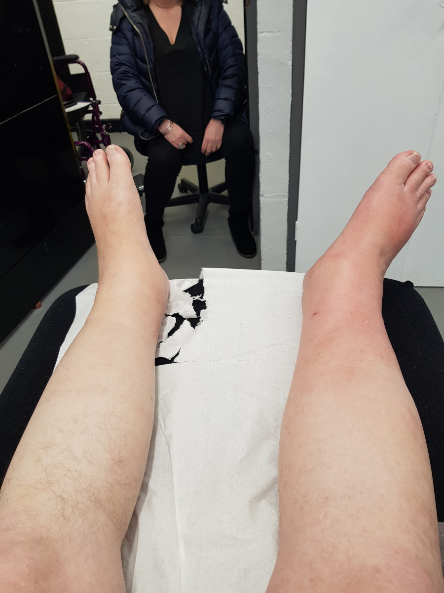 Multiple Sclerosis Edema Complications: Having a Swell Time