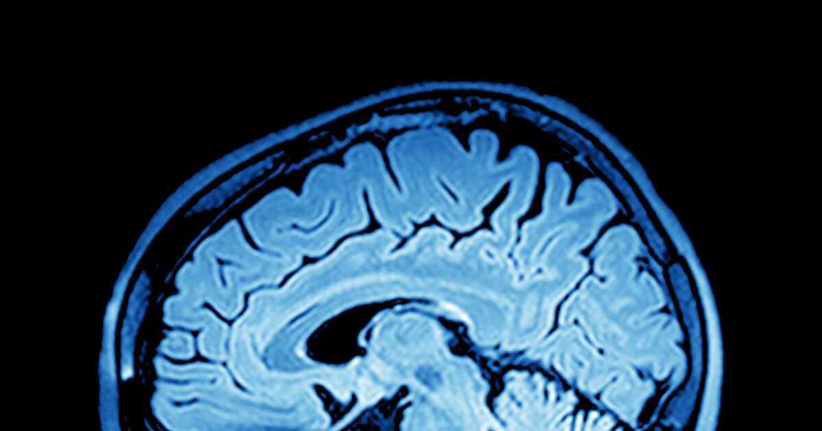 Brain Iron Levels Correlate with MS Progression, Disability Risk — Study