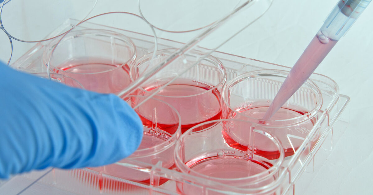 Trial Will Assess Mesenchymal Stem Cell Therapy for Progressive MS