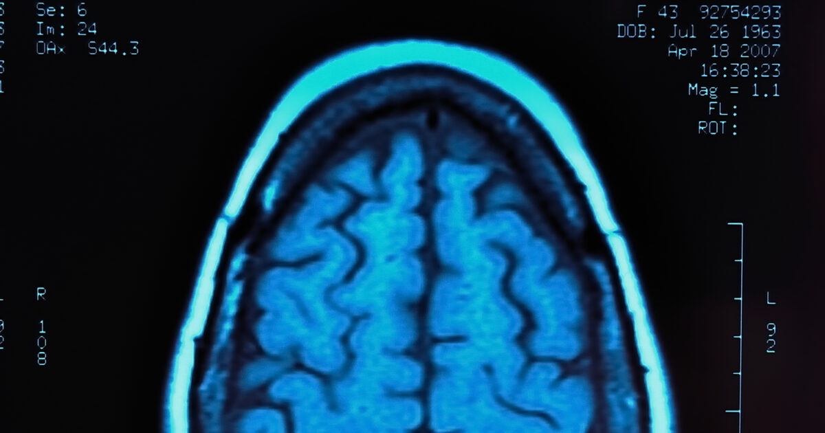 PET Scan Radiotracer May Help Identify Early Signs of MS Progression ...