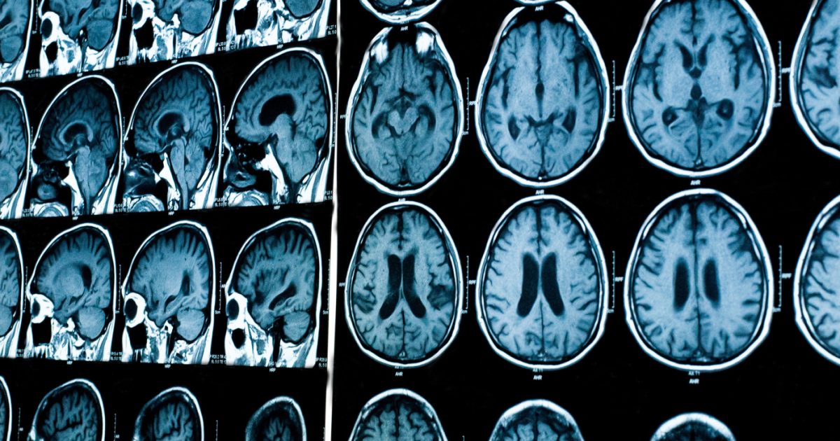 MS Has 3 Distinct Groups, Says Study of MRI Brain Patterns Using AI
