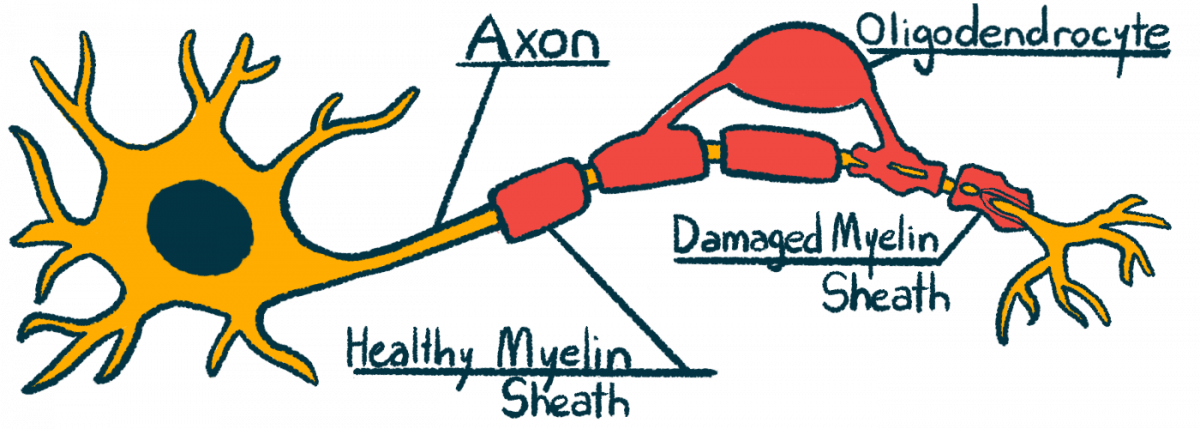 Does the Myelin Sheath Play a Role in MS?
