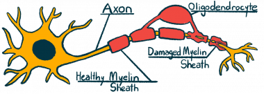 Does the Myelin Sheath Play a Role in MS?