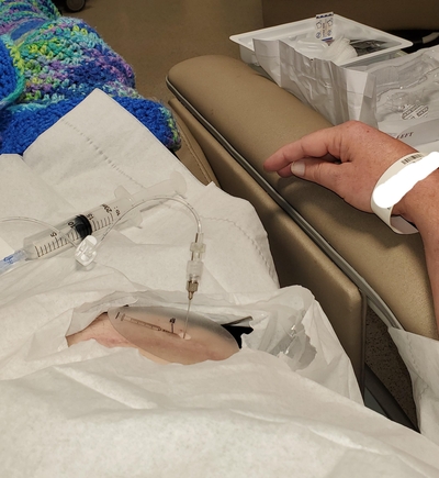 A Friend Under the Skin: My Intrathecal Baclofen Pump | Multiple ...