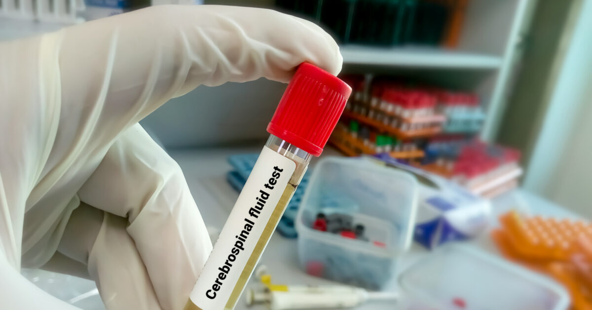 New CSF protein markers may help support diagnosis of MS