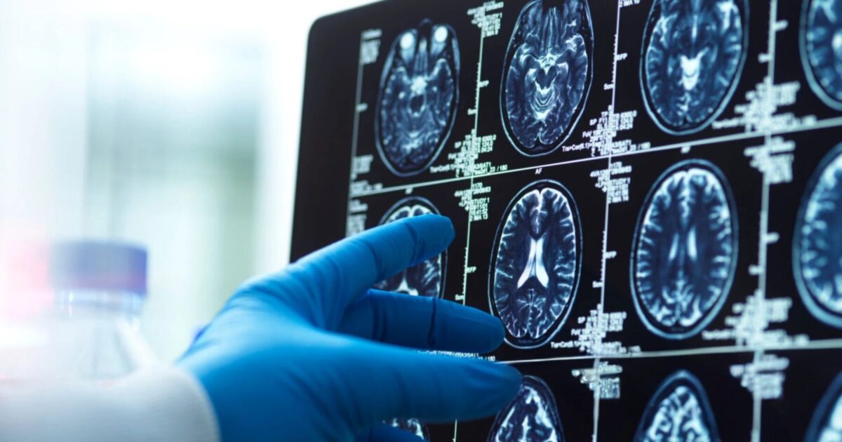 ACTRIMS 2026: Vidofludimus calcium targets key MS mechanisms