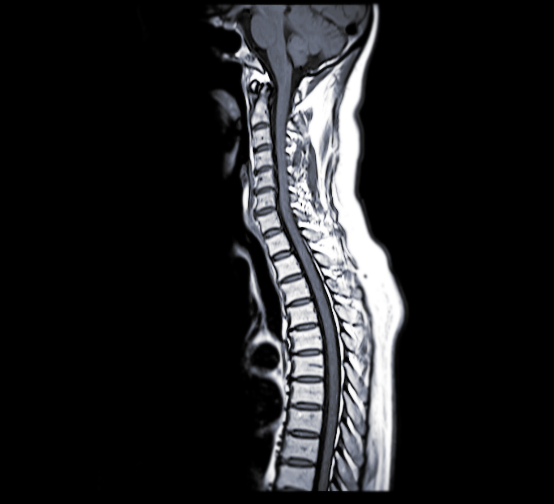 Routine MRI measure may flag higher risk of MS progression